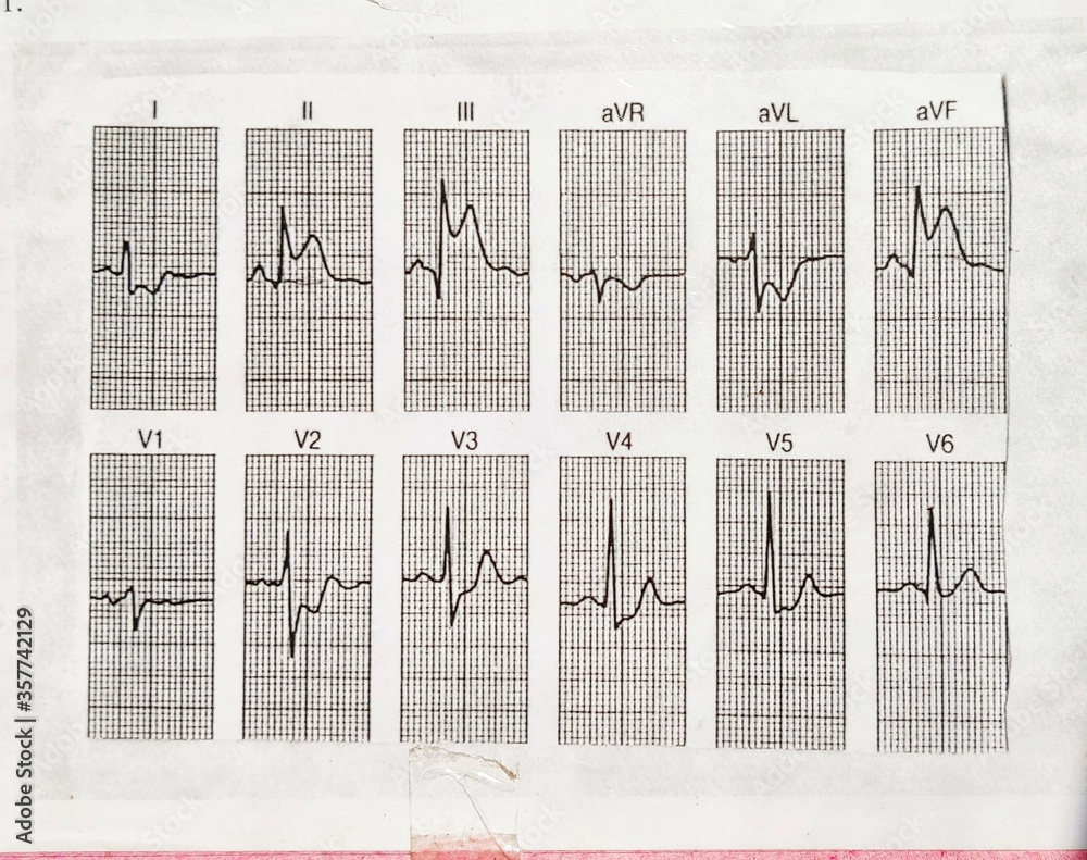 ECG report of normal Human being Stock Photo | Adobe Stock