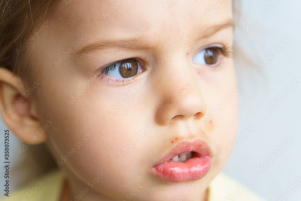 The face of a little girl with skin rashes is a close-up view ...