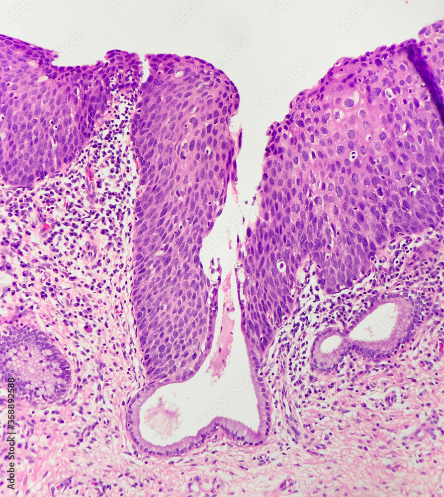 Cervical tissue displays severe dysplastic change, involving ...