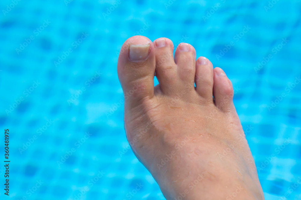 Webbed toes, woman Right Foot With Veins and Webbed Toes on blue pool ...