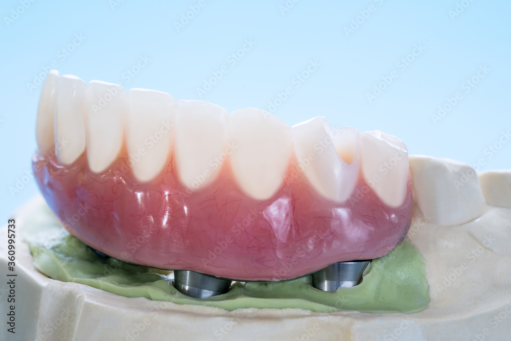 Dental implant work is completed and ready to use/ dental implant ...