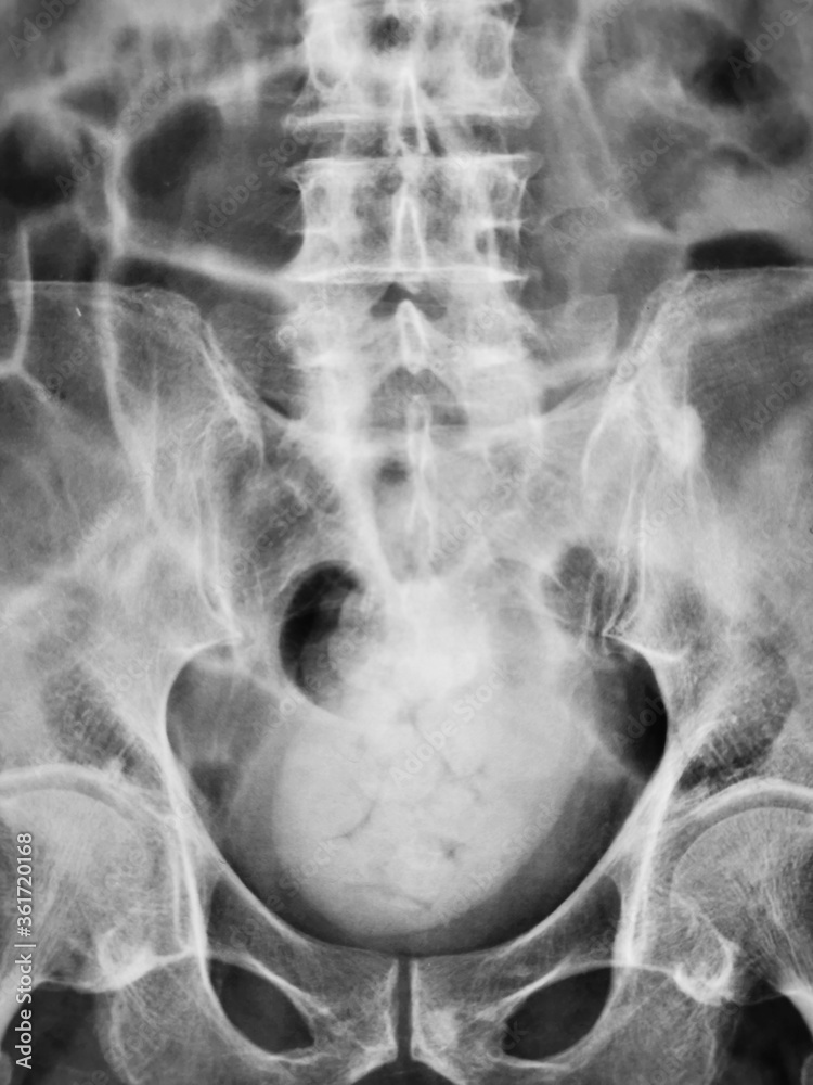x ray of a human Pelvis with huge laminated stone Stock Photo | Adobe Stock