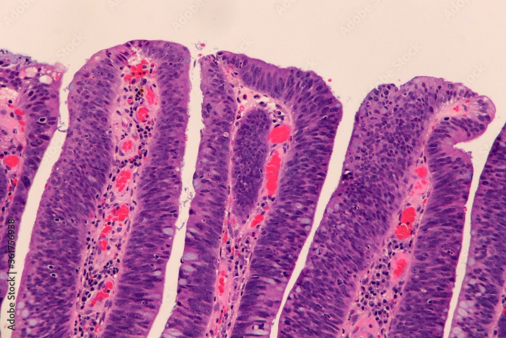 Surface of a colon polyp called a villous adenoma, showing enlarged ...