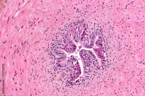 Cross section of normal vas deferens after a vasectomy. Sterilization ...