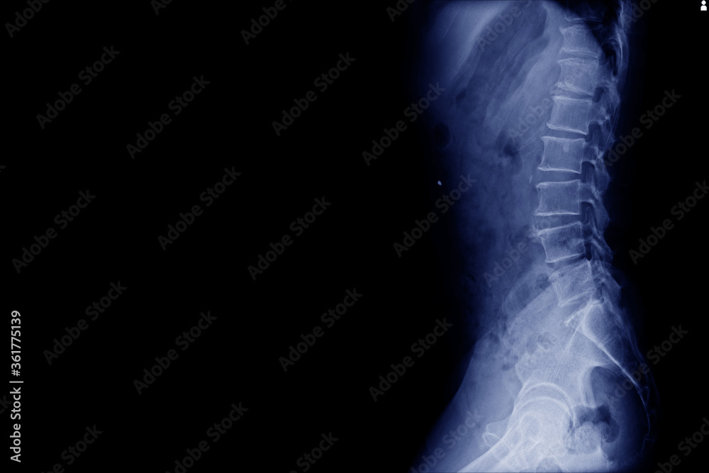 X-ray lumbo-sacral spine and pelvis No fracture, dislocation , bony ...