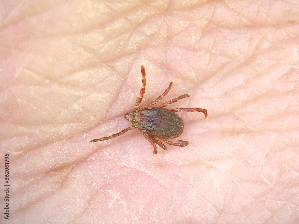 Tick on human hairy skin background. Ixodes ricinus or scapularis ...