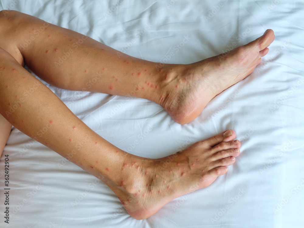 Female legs with many red spot and scar from sand fly bites Stock Photo ...