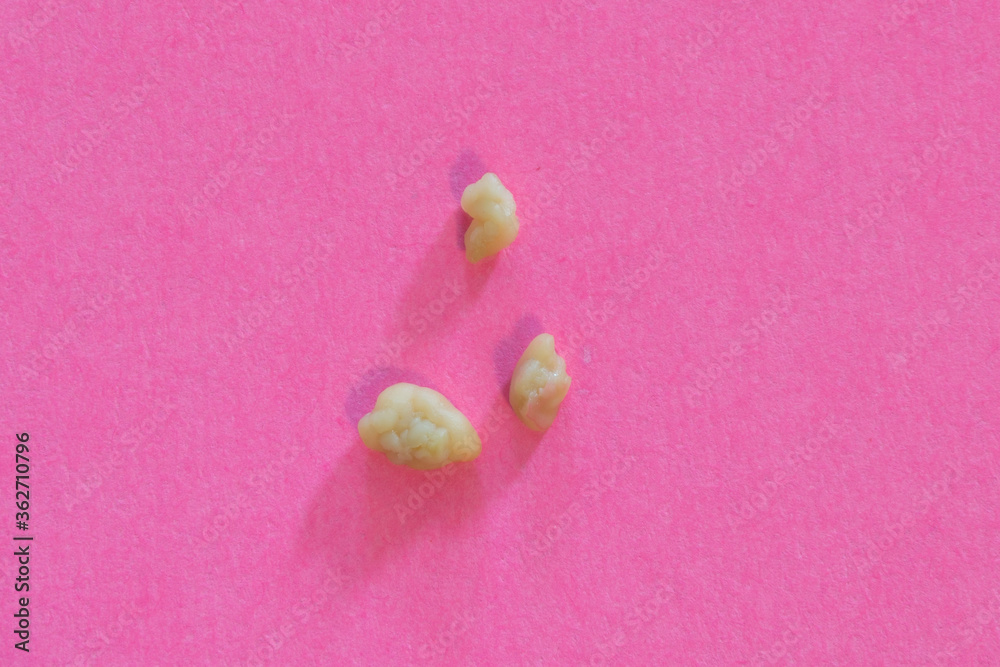 Tonsil stone (tonsillolith) on a piece of paper Stock Photo | Adobe Stock