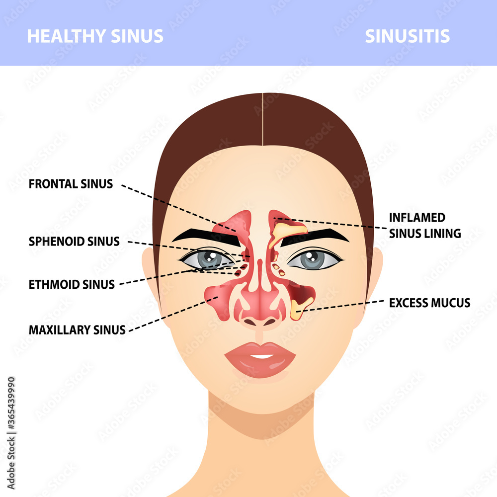 Sinusitis. Healthy and sinus infections, signs, realistic illustration ...