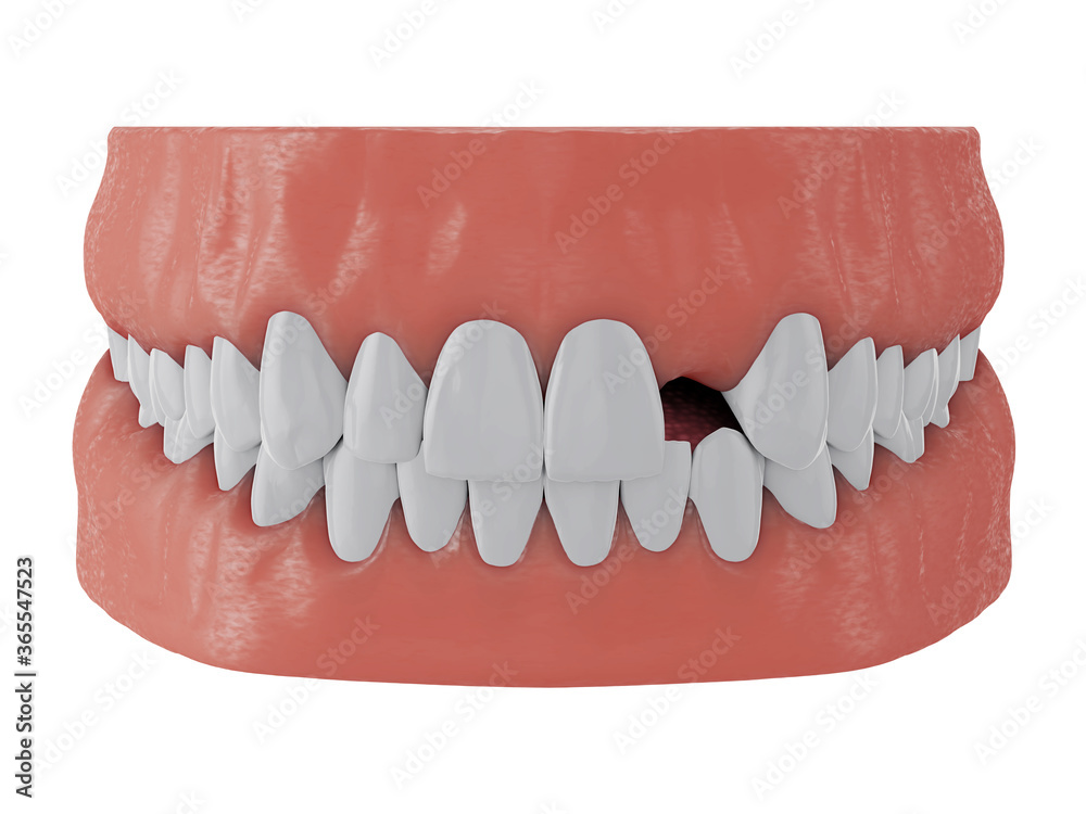 jaw with missing front tooth deuce on white background, 3d render Stock ...