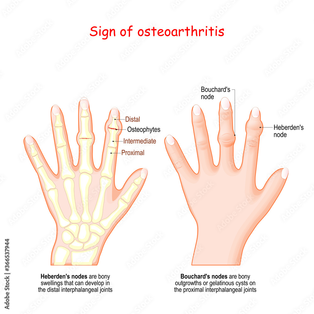Image vectorielle Stock Sign of osteoarthritis. Human hand with ...