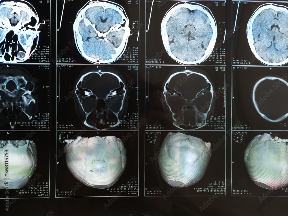 This stock photo shows a magnetic resonance imaging MRI of the brain ...