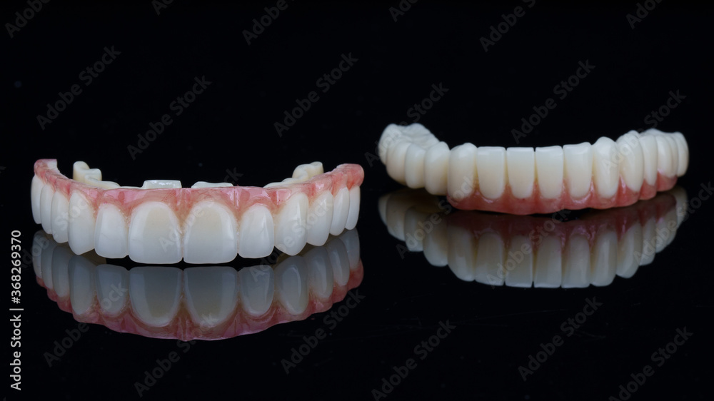 temporary dentures for the patient's upper and lower jaw after dental ...