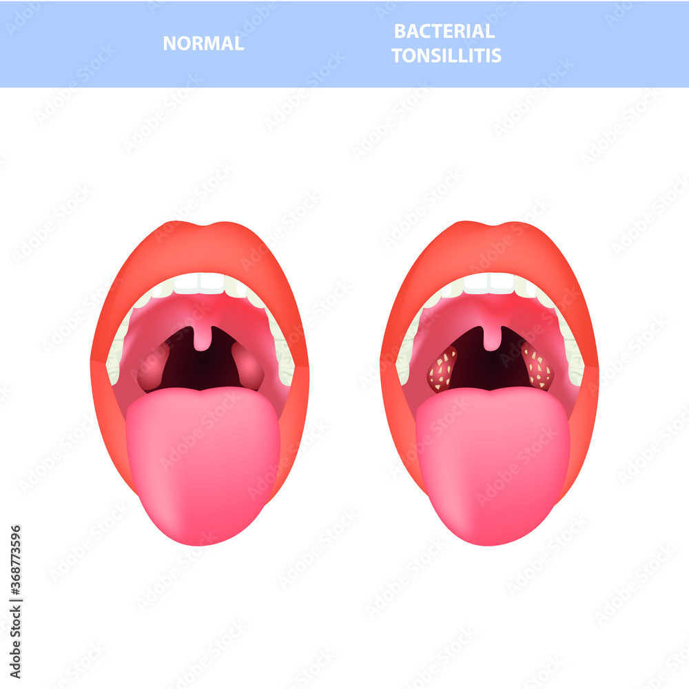 Open mouth, normal and Tonsillitis bacterial and viral. Angina ...