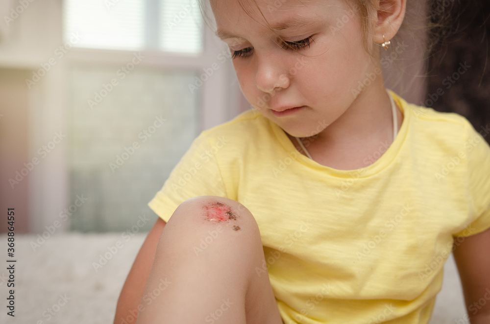 focus on broken baby knee. A little sad girl examines and processes her ...