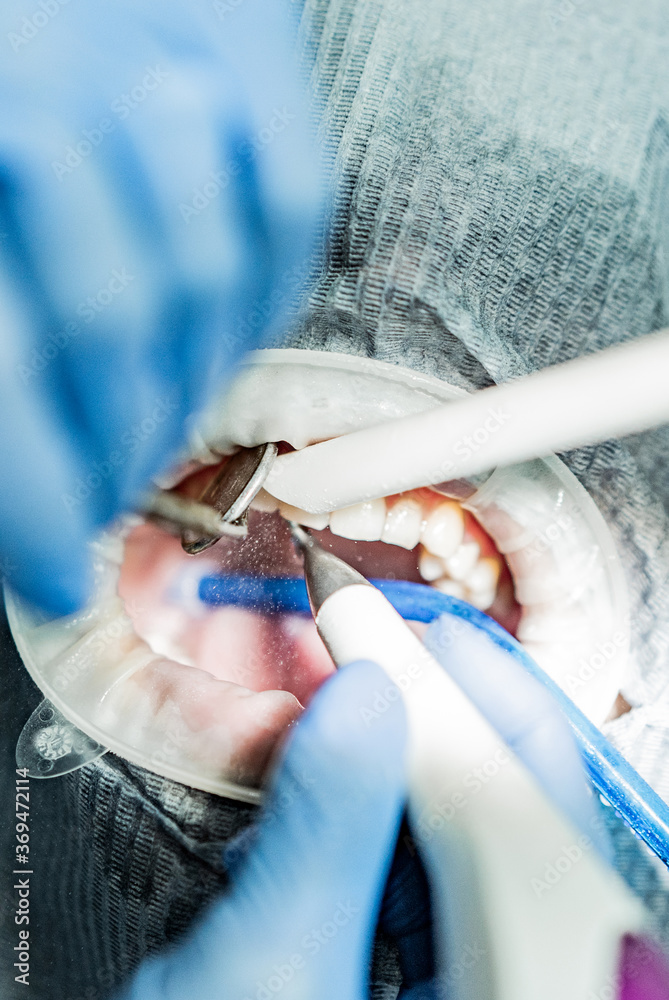 Open Mouth through optragate. Dentist office. Dentist making ...
