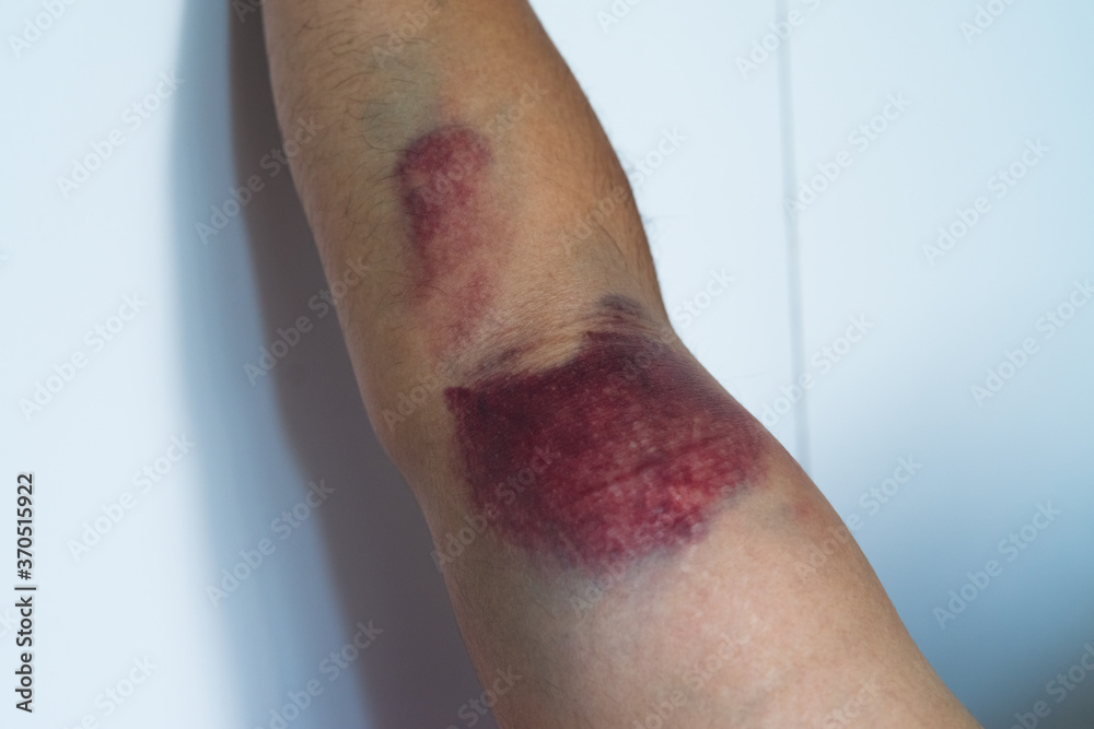 Bicep tear or strain, tendon injuries on a muscular man hand. Trauman ...