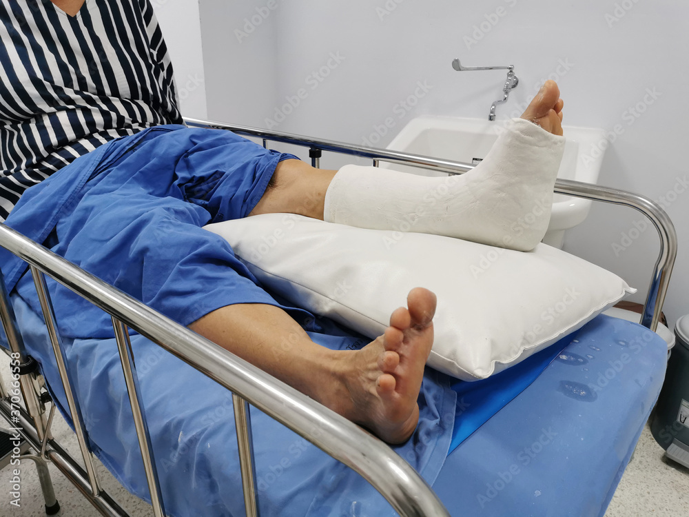 Stock-Foto „Patient woman with a broken leg from accident on nursing ...