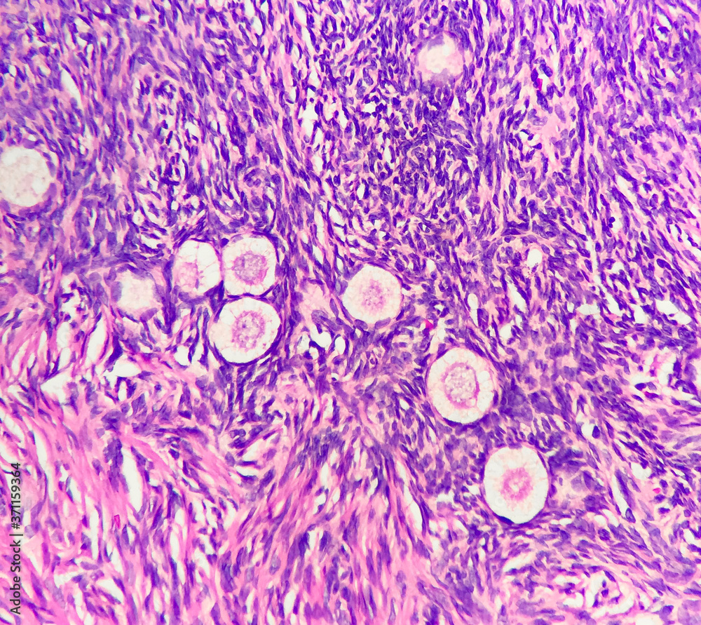 Photo of normal ovary, showing ovarian stroma, primordial follicles and ...