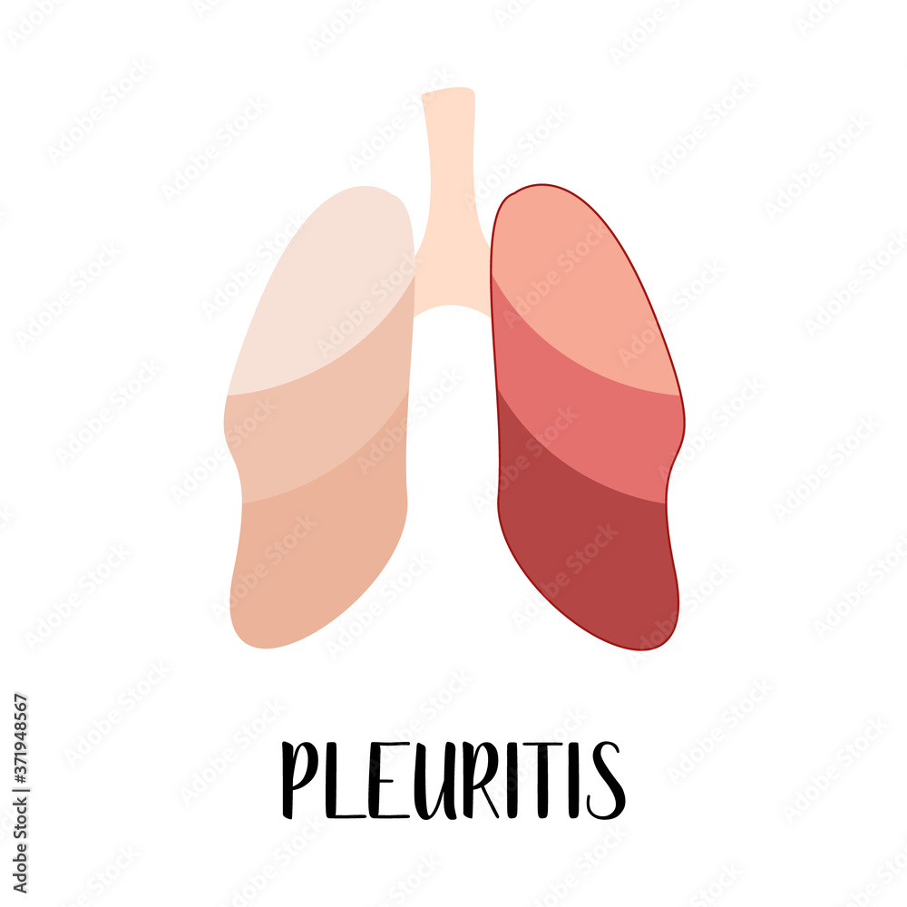 Pleuritis, pleurisy. Lungs disease. Pulmonology. Vector flat ...