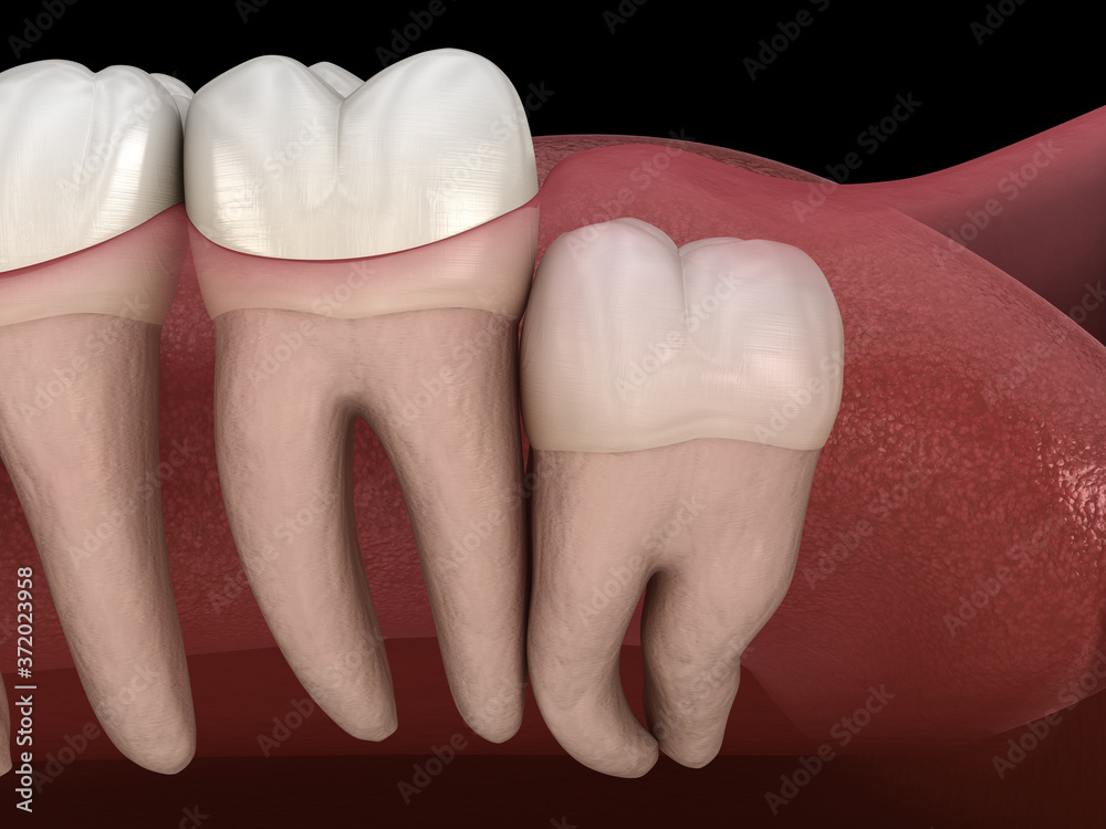 Wisdom tooth with impaction at molar tooth. Medically accurate tooth 3D ...