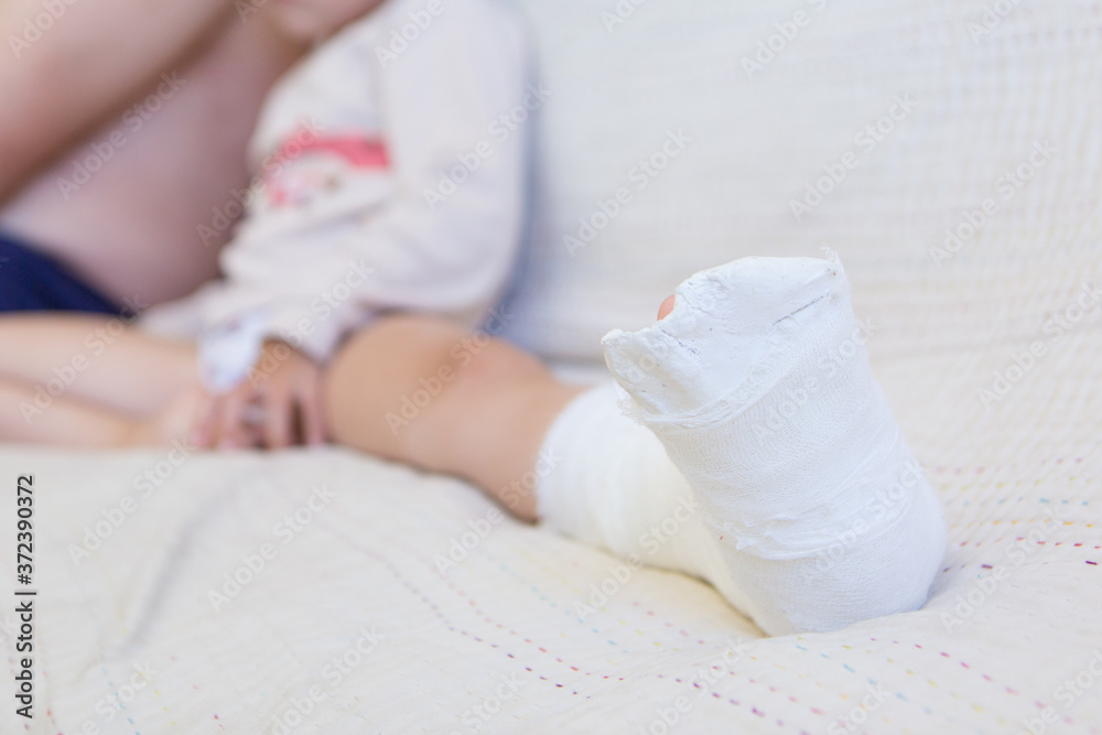 broken leg. Close-up of the cast on the feet. exercises to repair and ...