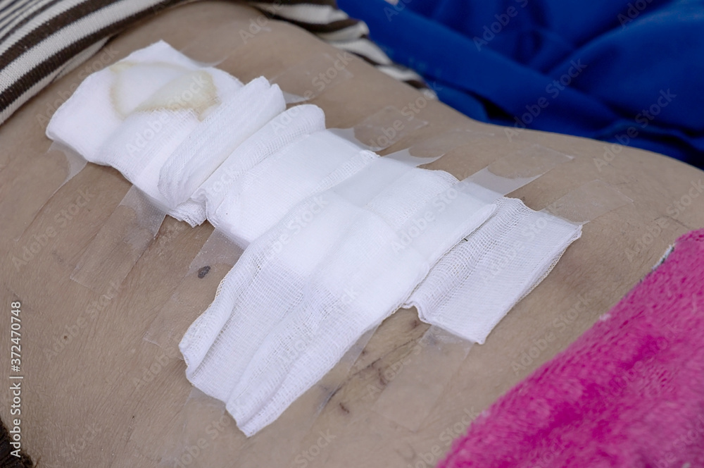 abdominal surgering wound Stock Photo | Adobe Stock