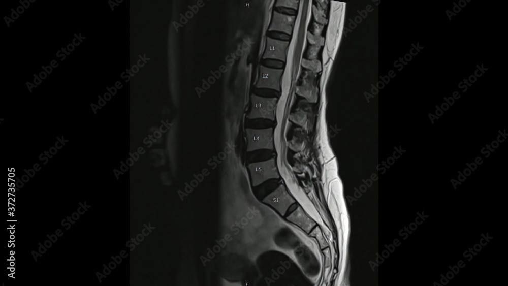 Stock-Foto „Magnetic Resonance images of Lumbar spine sagittal T2-weighted images (MRI Lumbar ...
