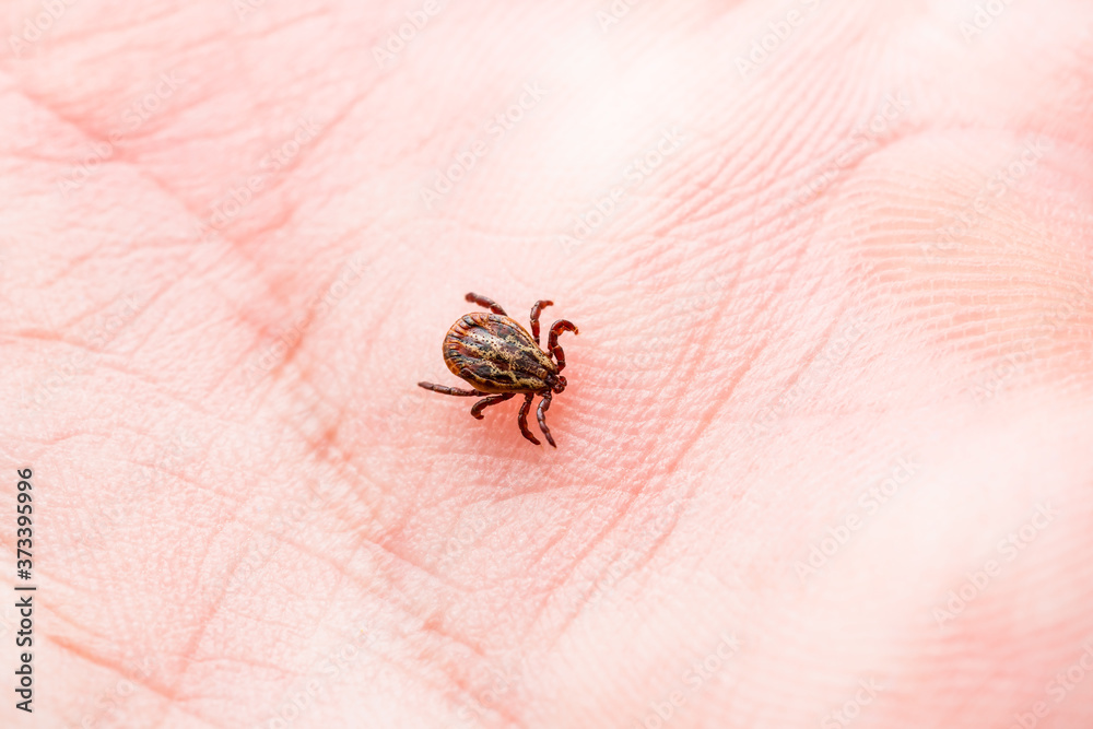 Infectious Encephalitis Tick Insect Crawling on Skin. Encephalitis ...