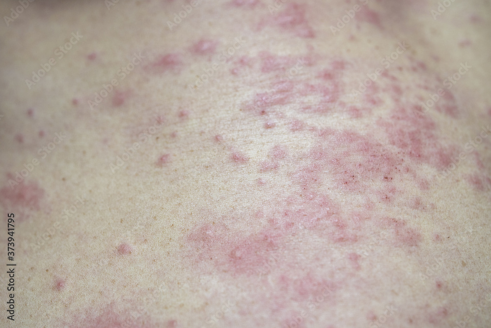 Itchy rash, Skin rash on body, Stock Photo | Adobe Stock