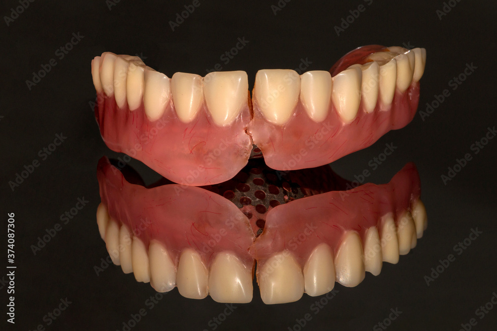 Removable denture with cast reinforcement. Full upper plastic ...