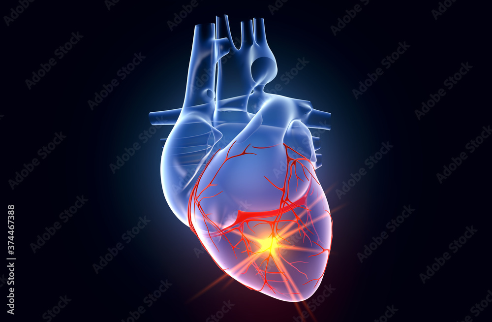 Cardiac infarction, myocardial infarction with ECG waves, medically ...