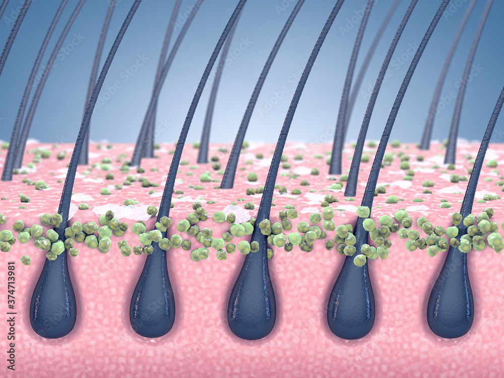 Dandruff prevention and antifungal treatment, Human scalp hair roots ...