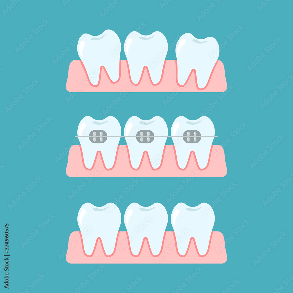 Stages of orthodontic treatment braces on teeth. Alignment of bite of ...