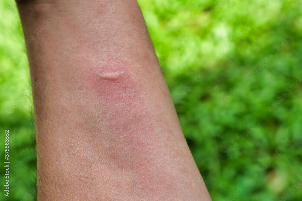 Symptoms of insect sting allergy. Rash on skin caused by insect bites ...