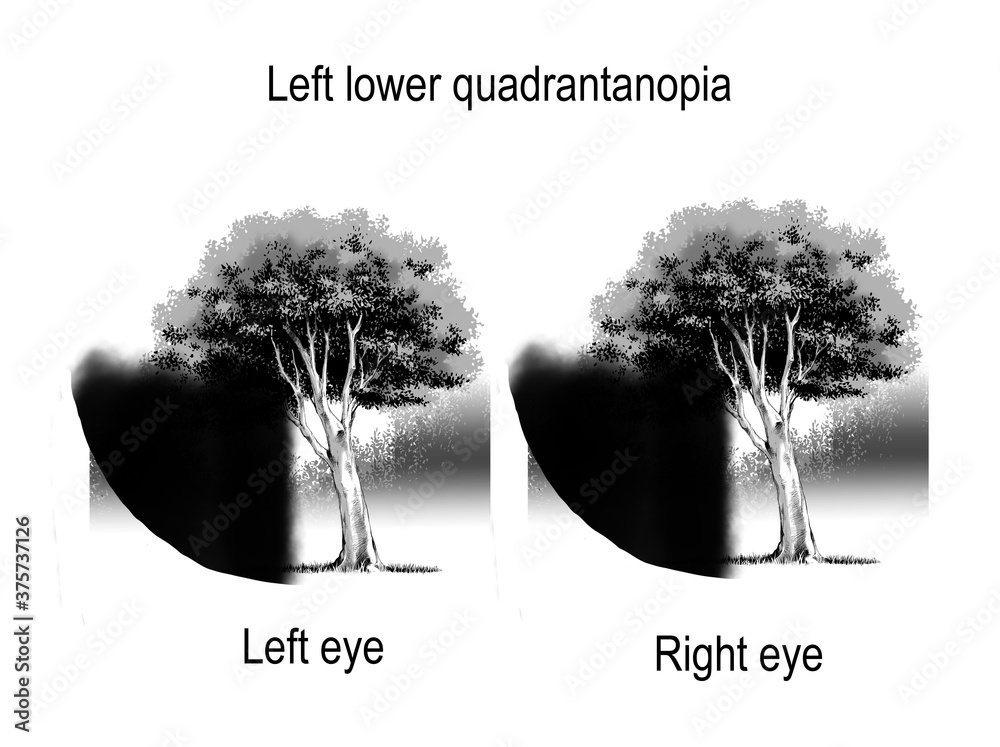 patterns of visual field defects are sign and symtomp of loss of vision ...
