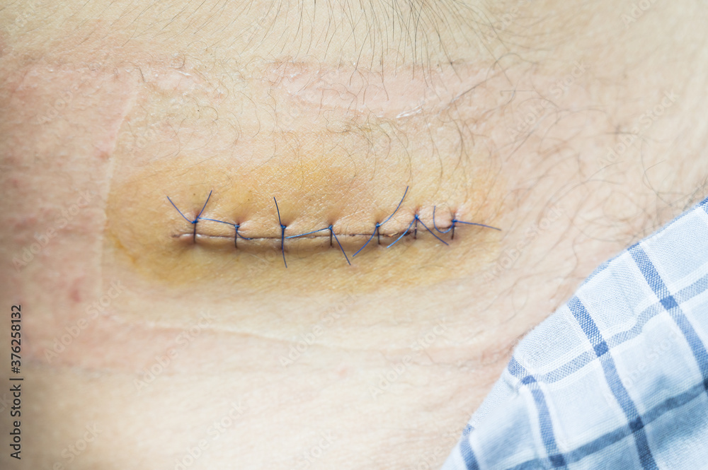 Nurse or Doctor hand treating the wound patient to clean the wound ...