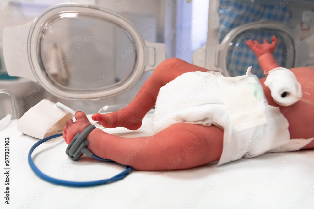 Premature baby feet with a neonatal pulse oximetry monitor, catheters ...