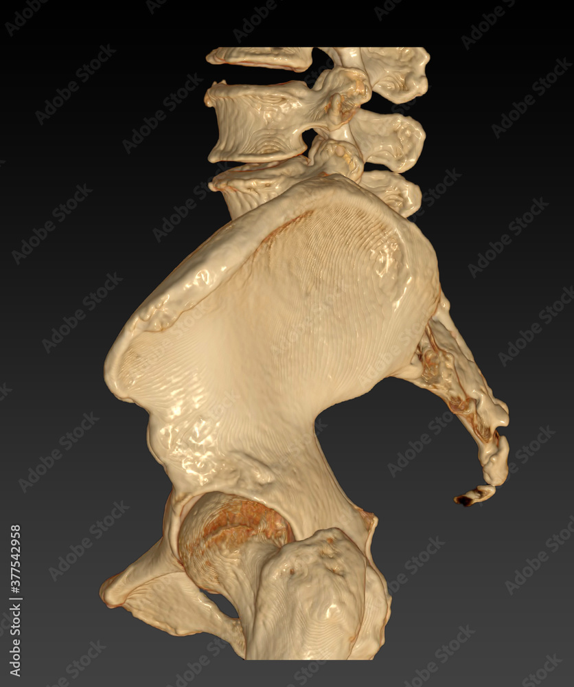CT Scan of pelvic bone with both hip joint 3D rendering image Laterla ...