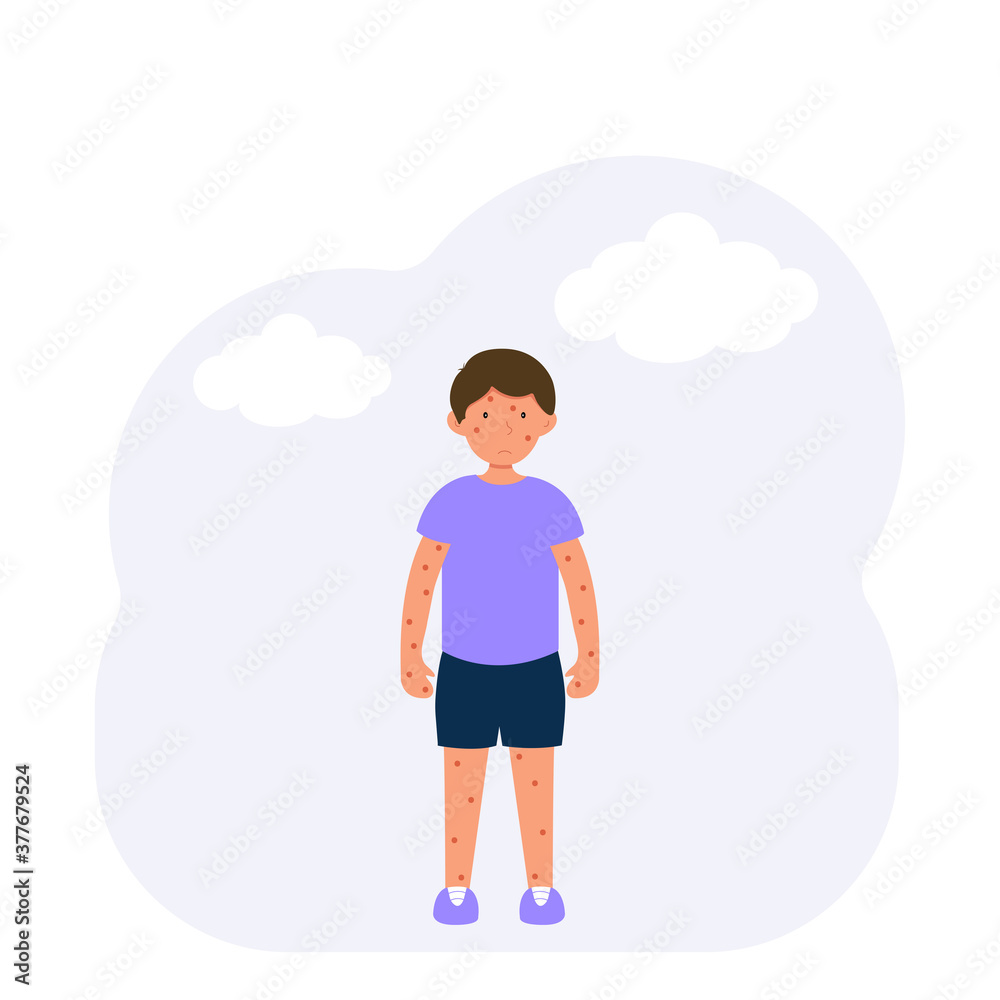 Flat vector illustration children allergy concept. Boy with hives on ...