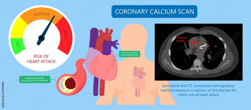 Cardiac Calcium Scoring chest health signs X-ray block treat blood ...