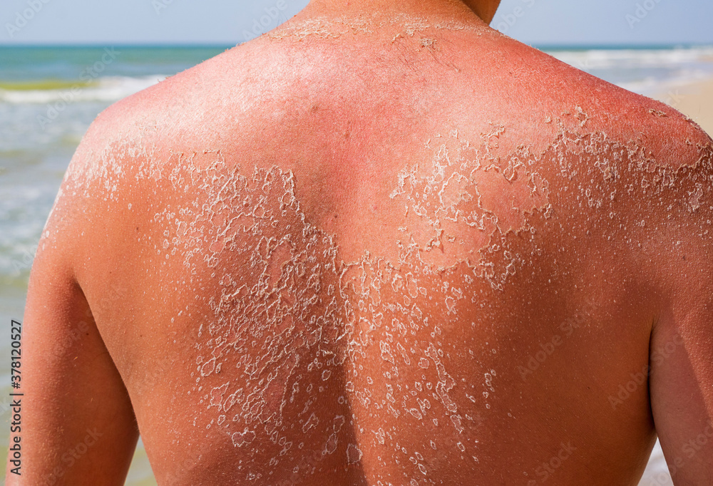 Dangerous sunburn on the sandy beach. Men with sun damaged peeling skin ...