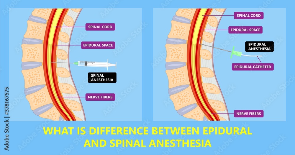 Epidural spinal block anaesthesia Pinched relieve General vaginal ...