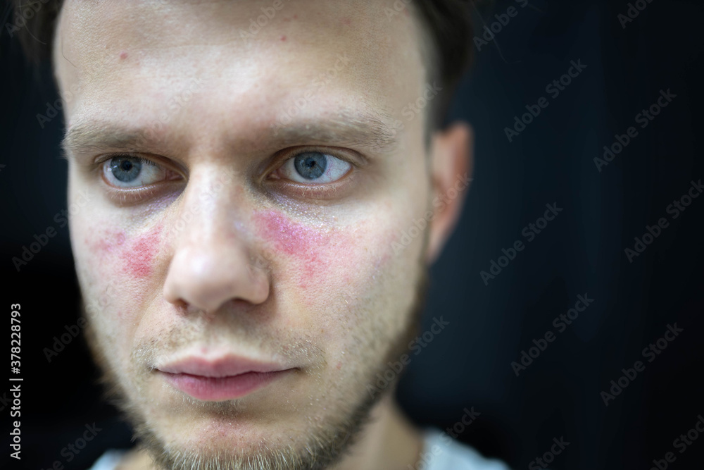 Foto de Stock man suffers from systemic lupus erythematosus, age spots ...