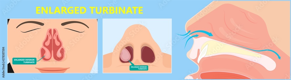 Turbinate hypertrophy ear ENT CPAP nose stop apnea block laser nasal ...