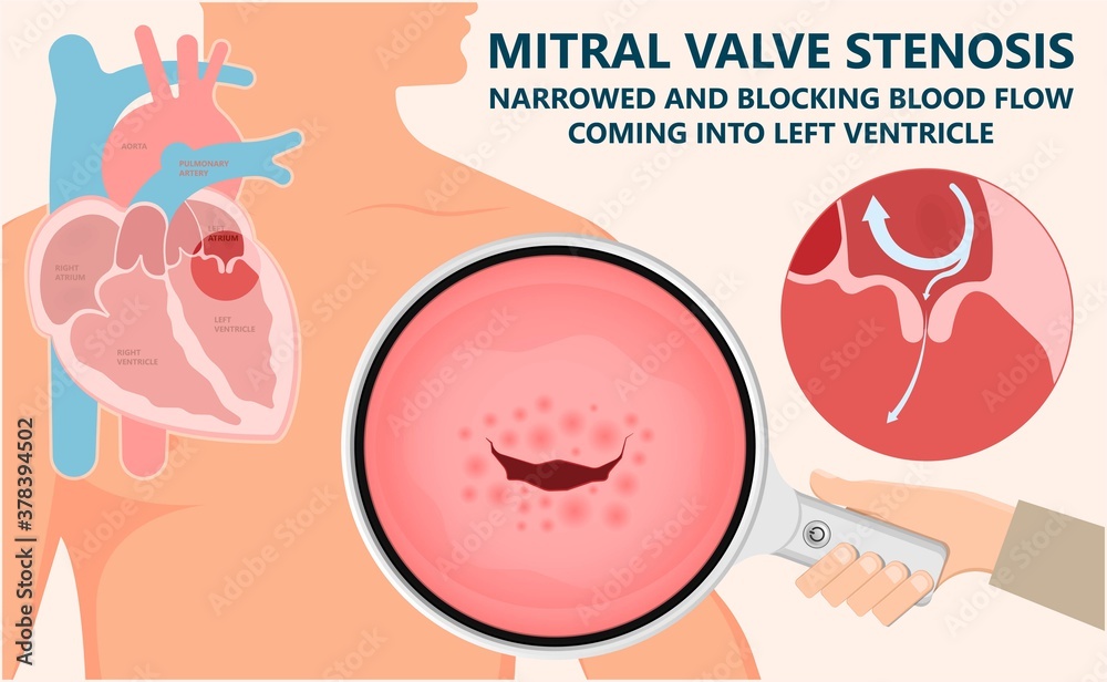 Cath Lab Atrial Septal Defect Tetralogy of Fallot Patent Foramen Ovale ...