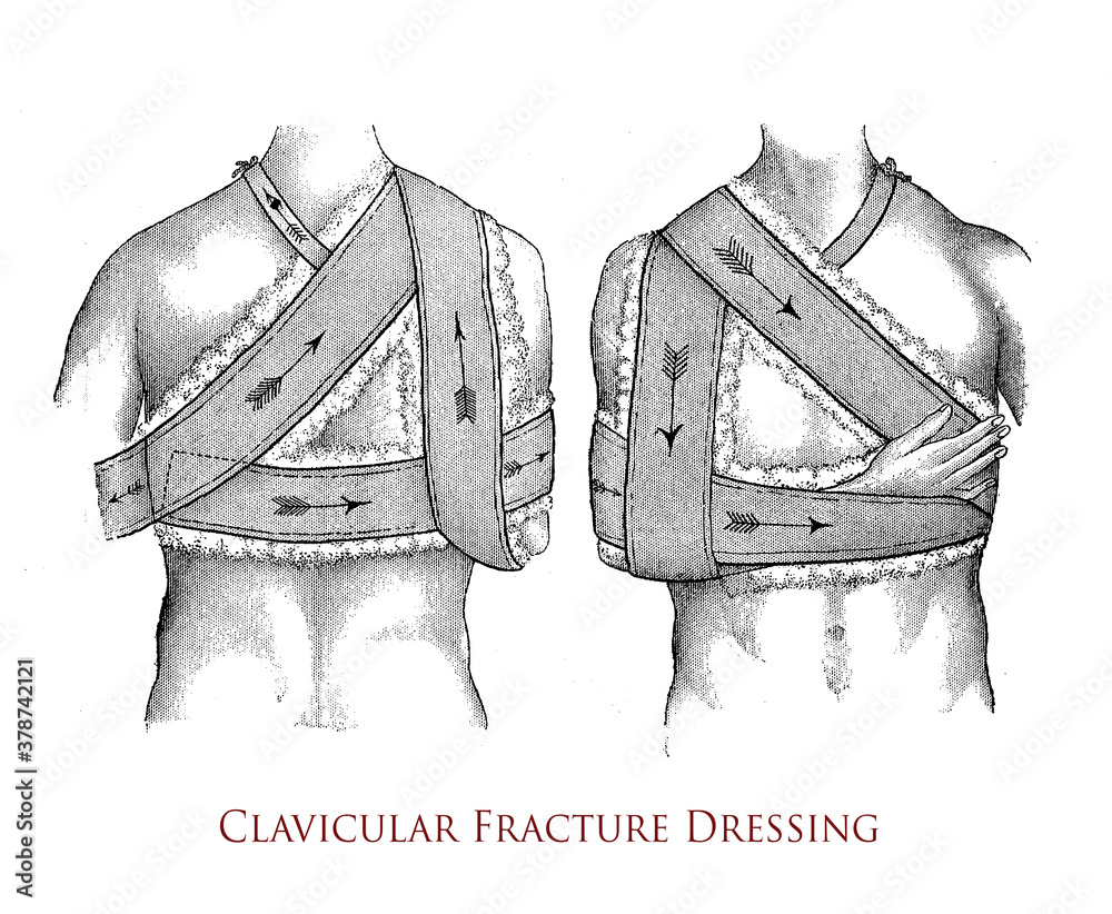 Healthcare and medicine: drawing explaining how to perform a clavicular ...