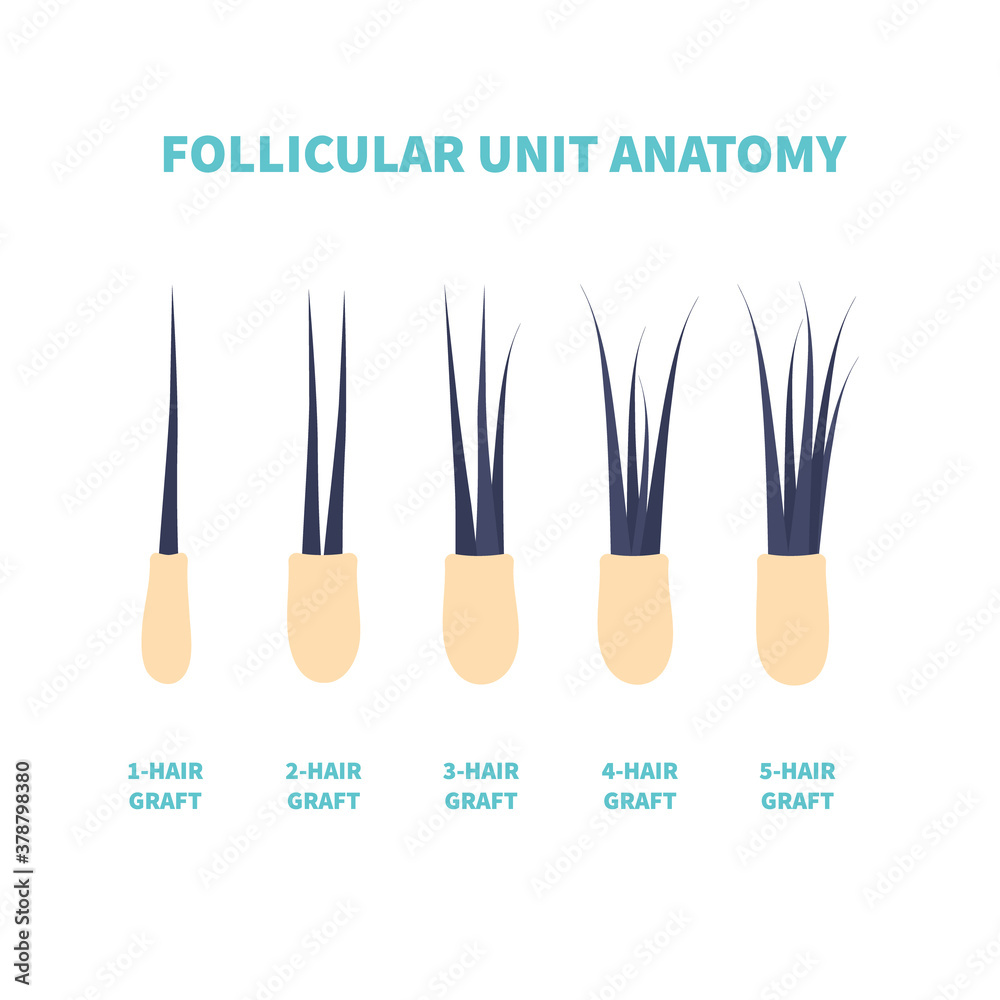 Hair micrograft classification set for hair transplantation surgery ...