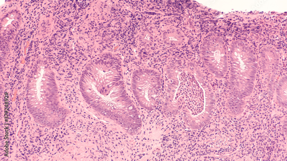Photomicrograph of a colon biopsy obtained during colonoscopy showing ...