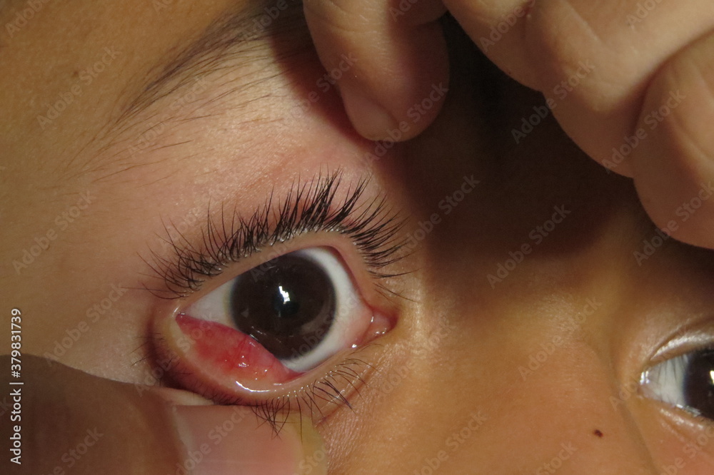 swelling of lower eyelid due to stye- calazion. view of nodule shaped ...